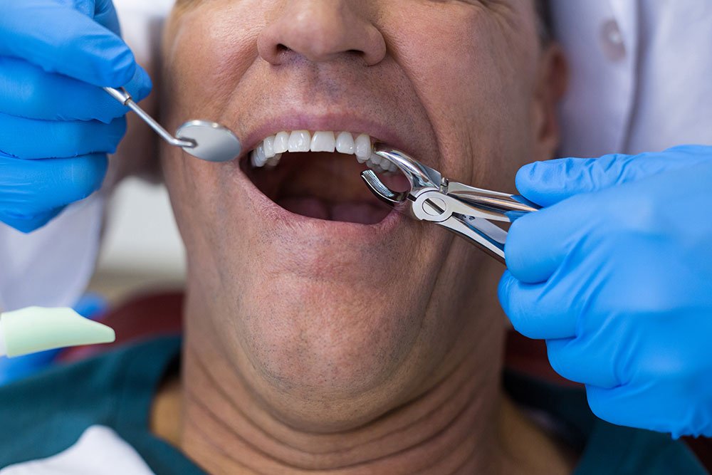 Fillings & Extraction – Cornflower Dental Clinic
